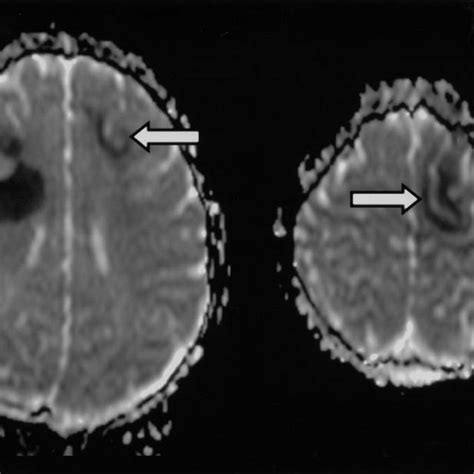 Apparent Diffusion Coefficient Maps Quantified Diffusion Magnetic Download Scientific Diagram