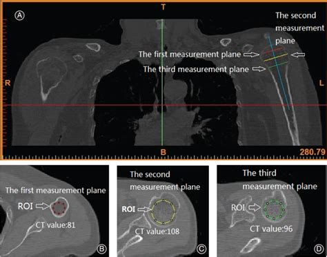 Method Of Measuring The Proximal Humerus Average Ct Value Ctmean A
