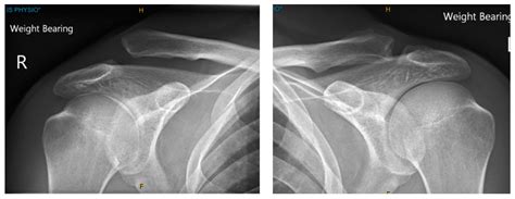 How To Rehab An Ac Joint Dislocation Stack Physio