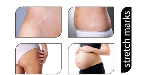 Stretch Marks Causes Treatment And Prevention