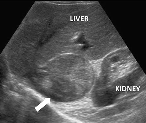 Adrenal Cancer Ultrasound Cancerwalls