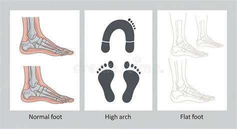 Comparative Foot Anatomy Normal High Arch And Flat Foot