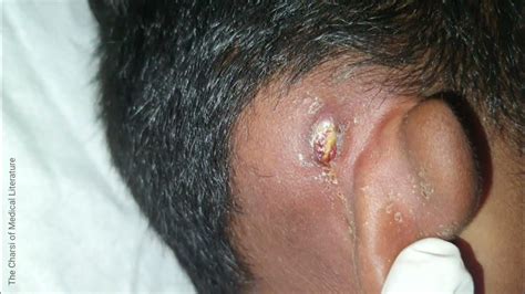 Mastoid Abscess Complication Of Otitis Media Youtube