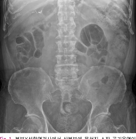 Figure 1 From Inflammatory Fibroid Polyp Of Ileum With Intussusception Semantic Scholar