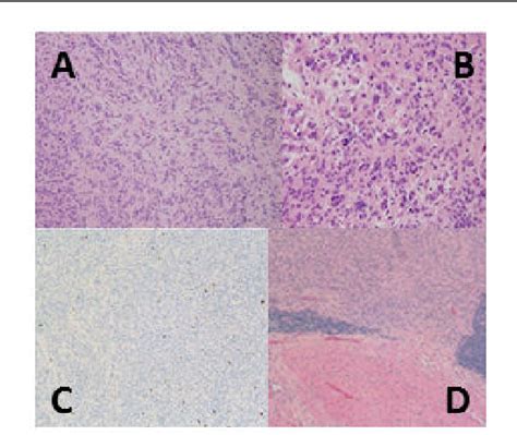Figure 1 From Indolent Gastrointestinal Neuroectodermal Tumor Gnet Of The Colon A New Entity