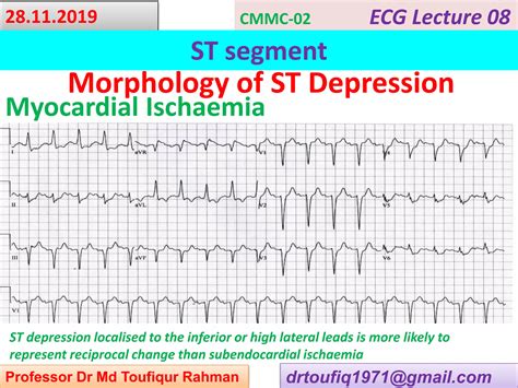 Ecg St Segment Ppsx Ecg St Segment Ppsx