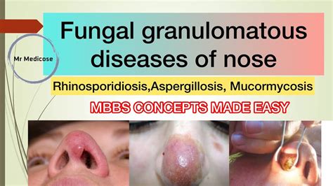 Fungal Granulomatous Diseases Of Nose Rhinosporidiosis