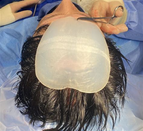 Male Custom Forehead Implant On Patient Intraop Dr Barry Eppley Explore Plastic Surgery