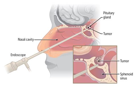 Hyperpituitarism Diagnosis And Management Flashcards Quizlet