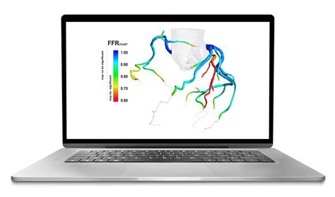 Medicalgorithmics Begins Vcast Technology Certification In The European