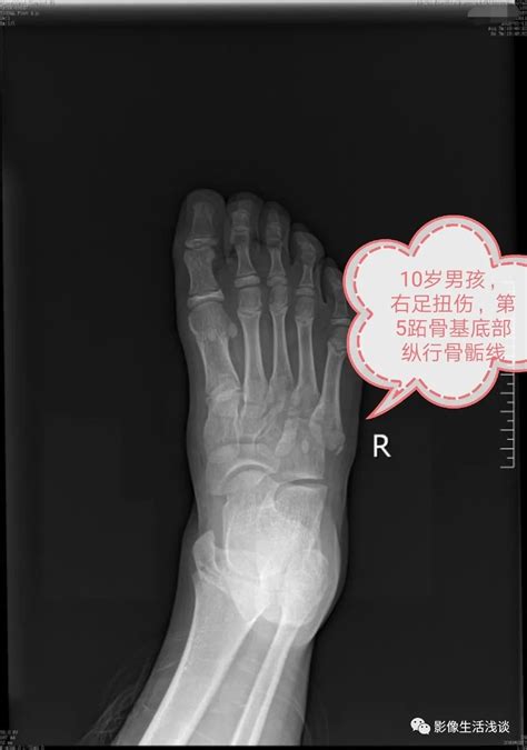 儿童第五跖骨基底部骨折与骨骺线的鉴别分析浅谈 上海开为医药科技有限公司 创伤、肢体矫形技术解决方案的专业服务商