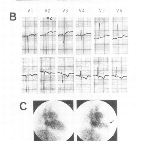 A Pyrophosphate Scan Of A 40 Year Old Man With A Prior Anteroseptal Download Scientific