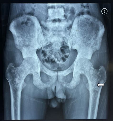 X‐ray Showed That There Were Multiple Patchy And Nodular High‐density Download Scientific