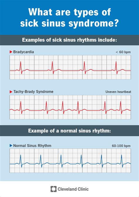 Sick Sinus Syndrome