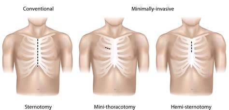 Minimally Invasive Aortic Valve Surgery Cardiac Surgery And Lung