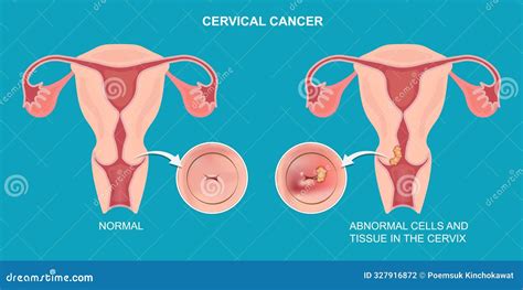 Cervical Cancer Is A Growth Of Cells That Starts In The Cervix Stock