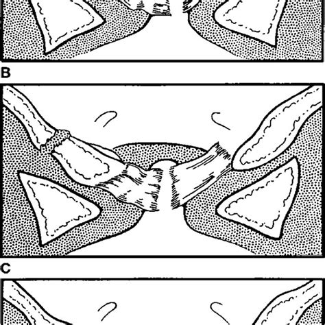 Type Iii Occipital Condyle Fractures Download Table