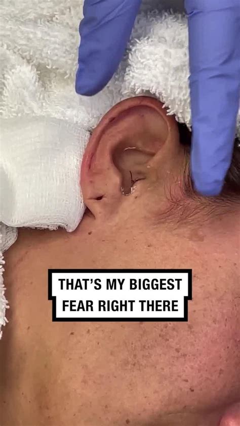 Best 13 Chemist Explains Pimple Removal On Scalp Artofit