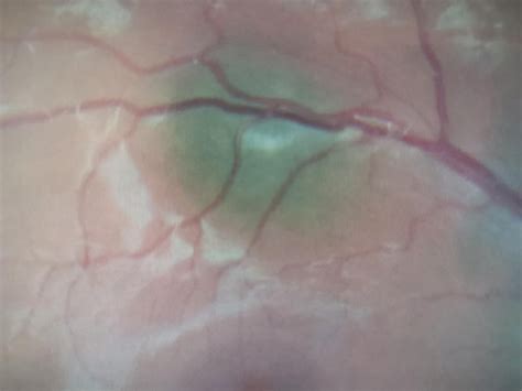 Choroidal Neavus R Ophthalmology