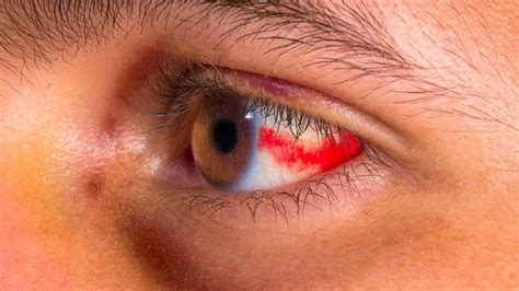 Sangre En El Ojo Causas Síntomas Y Tratamientos Posibles
