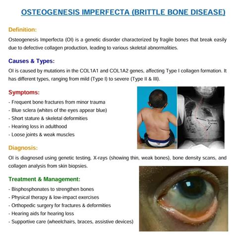 Osteogenesis Imperfecta Prognosis
