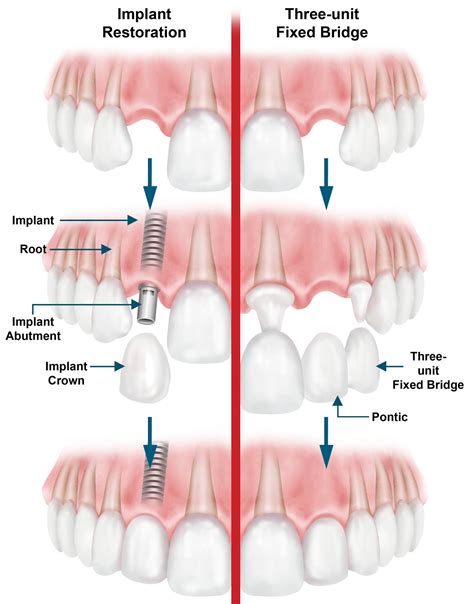 Dental Implant Vs Permanent Bridge At Flor Jackson Blog