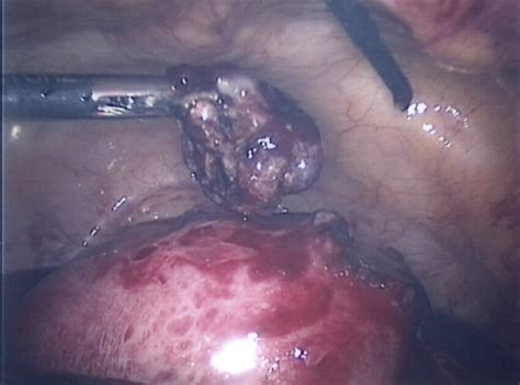 Right Cornual Ectopic Pregnancy Resected Download Scientific Diagram