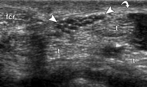Musculoskeletal Ultrasound Focused Impact On Mri Ajr