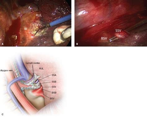 Video Assisted Thoracoscopic Right Superior And Basilar Segmentectomy Master Techniques In