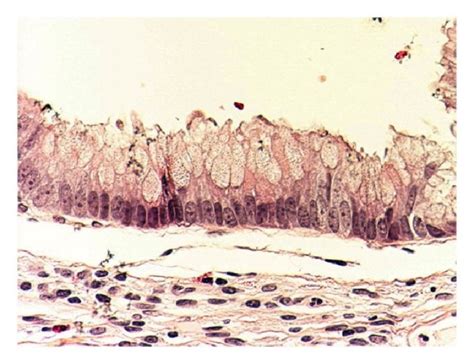 Photomicrograph Showing Appendiceal Mucosal Mucinous Hyperplasia With Download Scientific