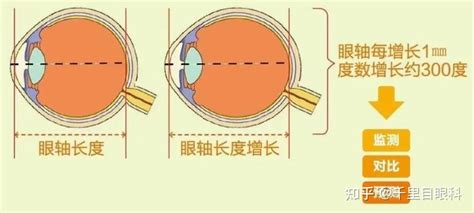 干货眼轴长度对照表 知乎
