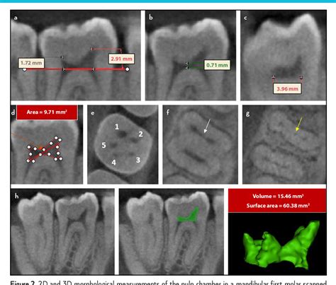 Figure 2 From The Study And Relevance Of Pulp Chamber Anatomy In