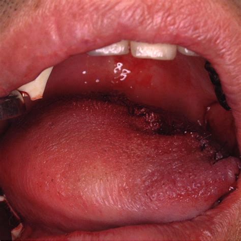 Ct Showing A Primary Tumour In The Right Glossotonsillar Sulcus Black Download Scientific