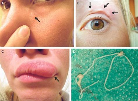 A Weird Lump On A Womans Face Turned Out To Be A Worm Crawling Under Her Skin Live Science