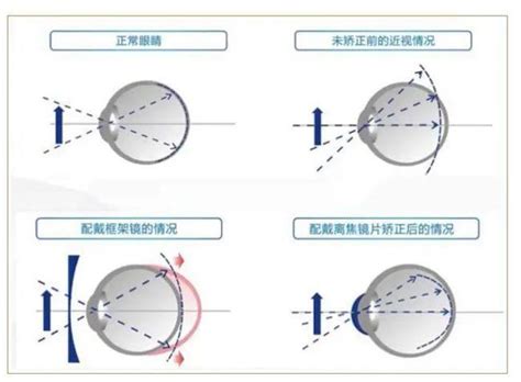 周边离焦镜片防控的原理是什么？ 知乎