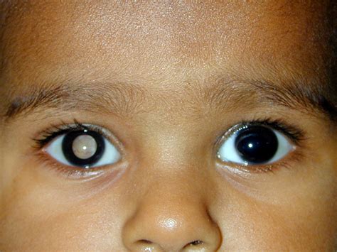 Retinoblastom Risiko Risiko Und Ursache Vom Retinoblastom Mdms