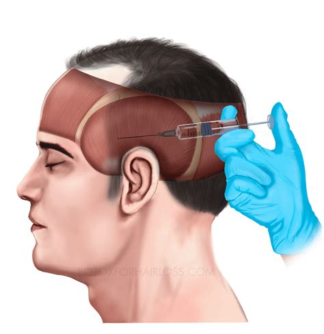 Botox For Hair Loss How Scalp Botox Works