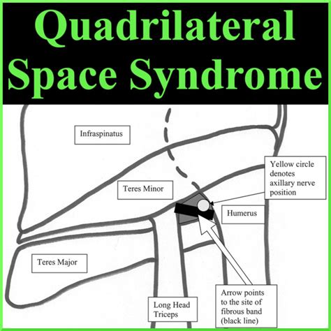 Quadrilateral Space Syndrome Sports Medicine Review