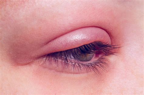 Blepharitis Eyelid Inflammation