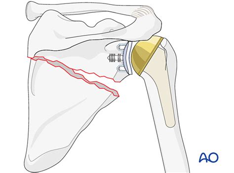 Orif Plate Fixation For Body Of The Scapula