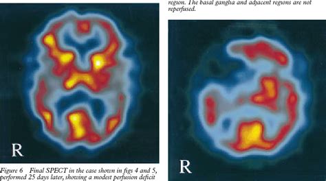 First SPECT In Case At Days Showing A Perfusion Deficit In The Download Scientific
