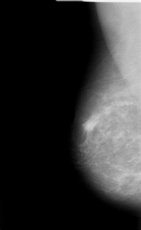 Breast Cancer Detection Object Detection Dataset By Yolo Objectdetection