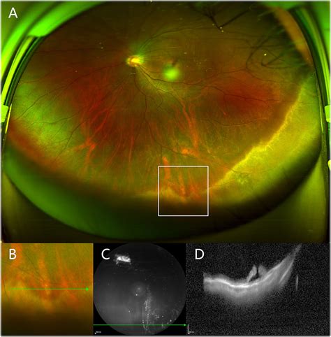 Frontiers Classification Of Peripheral Vitreoretinal Interface