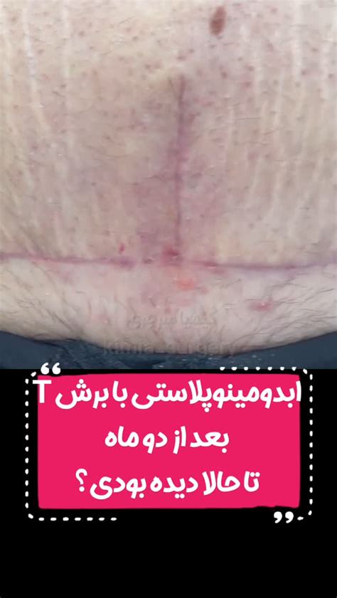 ‎پیکرتراشی کیمیا لیپوماتیک پروتز سینه ابدومینوپلاستی‎ Kimia