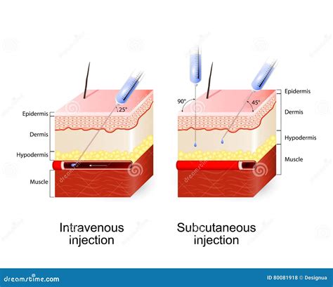 Intravenous Injection Diagram