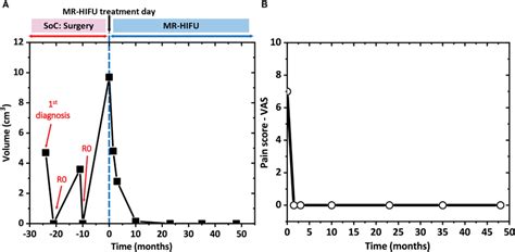 A Desmoid Tumor Response Over 6 Years After The First Diagnosis The Download Scientific
