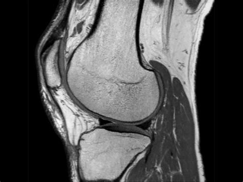 Comprehensive 3d Knee Imaging With Msk View Philips Mr Body Map
