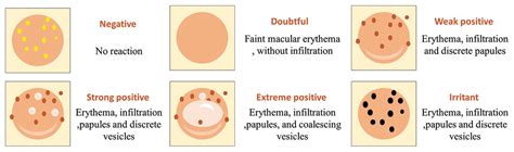 Allergic Patch Testing In Dermatology Indian Journal Of Postgraduate Dermatology