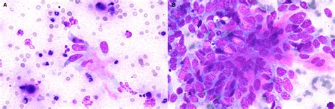 Cytologic Features Of Reactive Fibroplasia In Cutaneous And