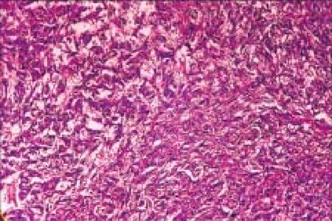 High Power Microscopic View Shows Pheochromocytoma Download